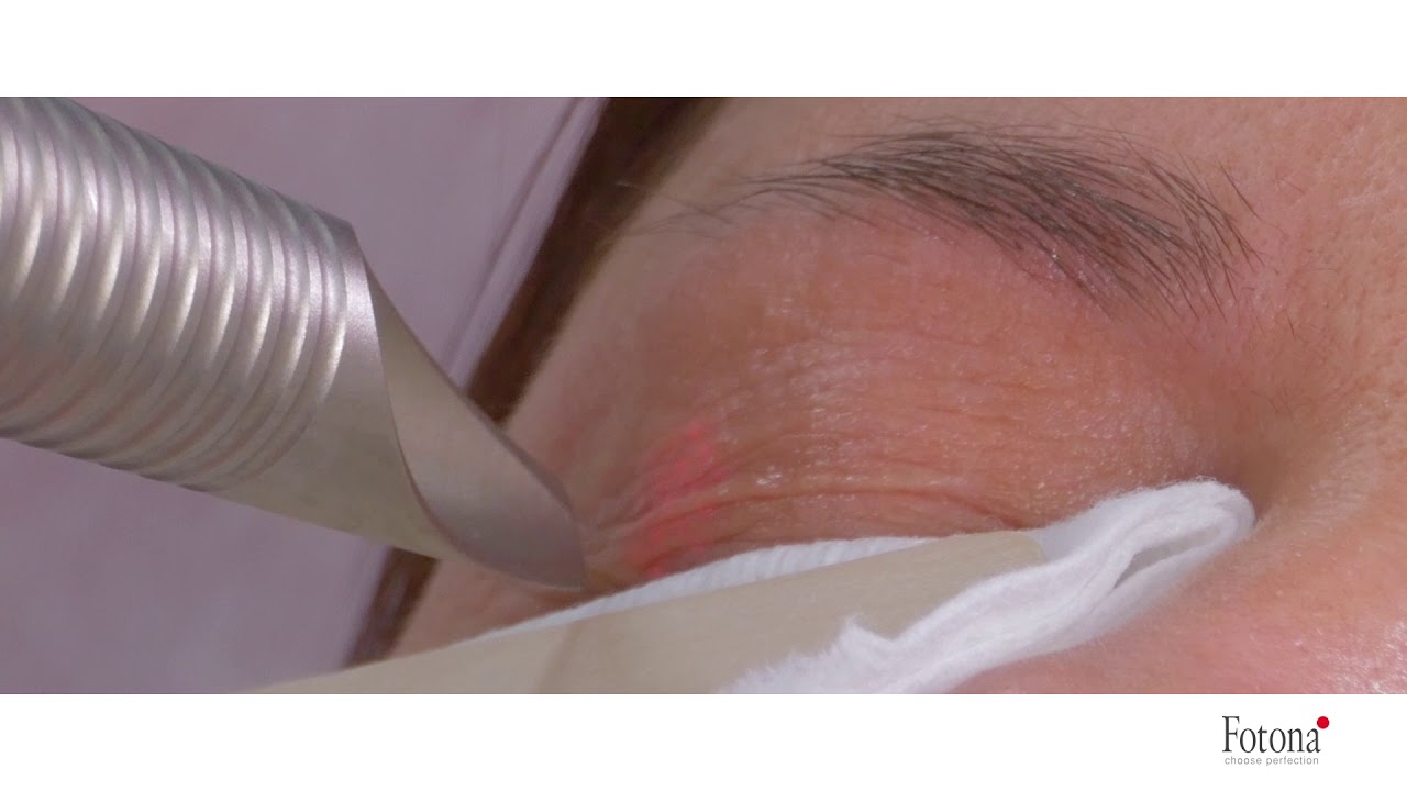 Fotona 4D – Deluxe Cosmetic Center